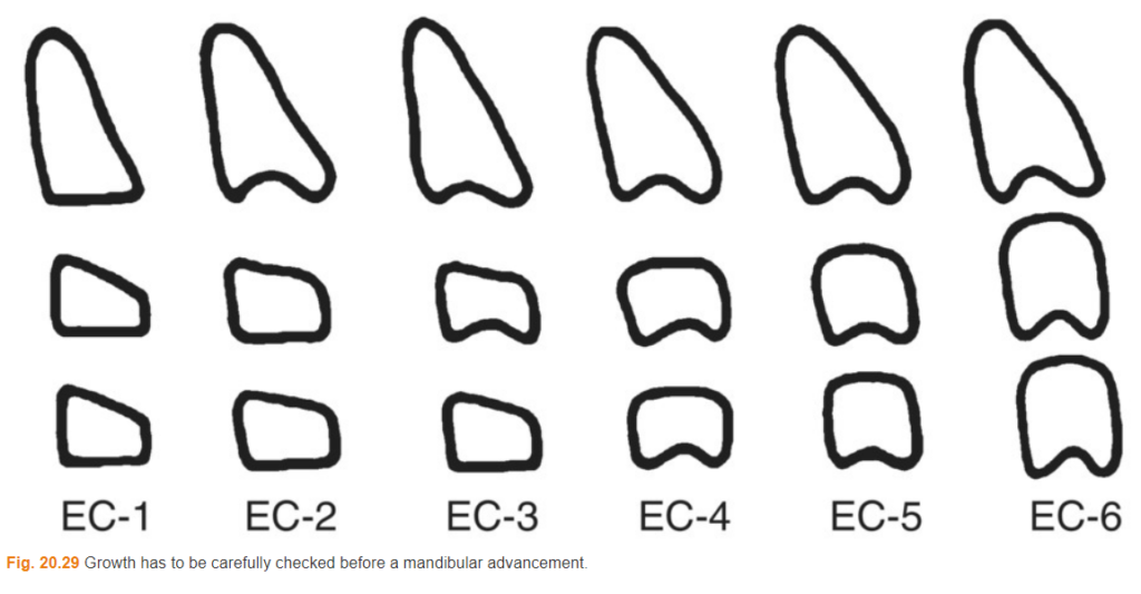 Ideal Moment for Mandibular Advancement – Aligner ABC