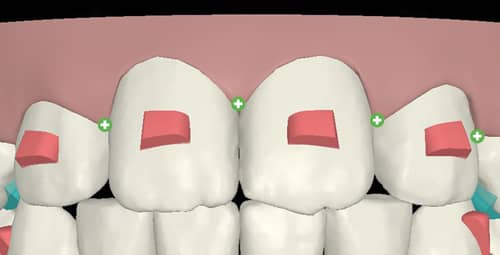 Root torque – Aligner ABC