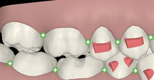 Anterior open bite – Aligner ABC
