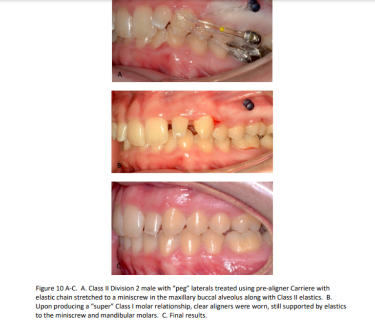 Distalization with TAD and Carriere motion – Aligner ABC