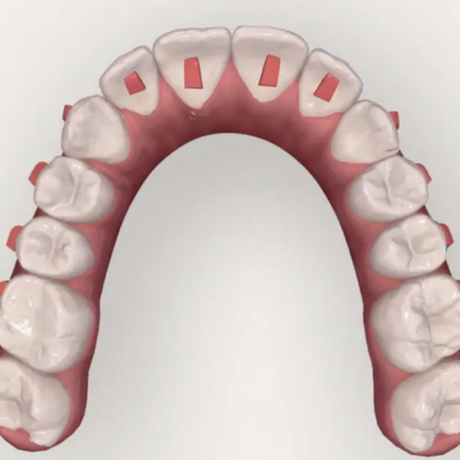 Anterior open bite – Aligner ABC