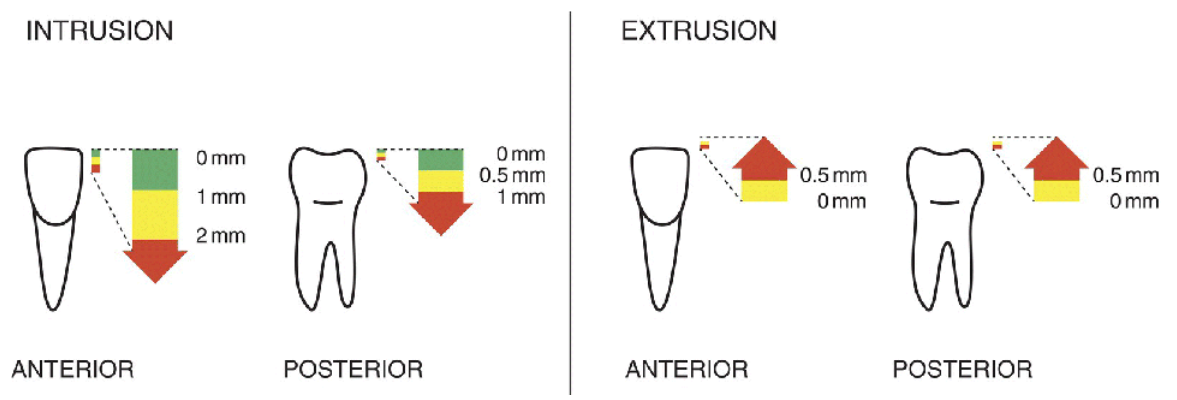 Anterior open bite – Aligner ABC