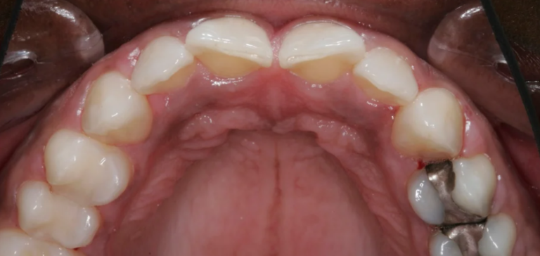 Anterior tooth rotation – Aligner ABC