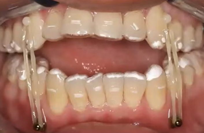 Open bite with TADS – Aligner ABC