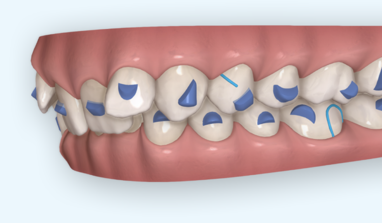Root torque – Aligner ABC
